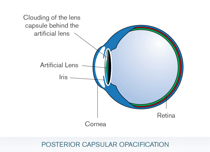 YAG laser capsulotomy - David Gartry